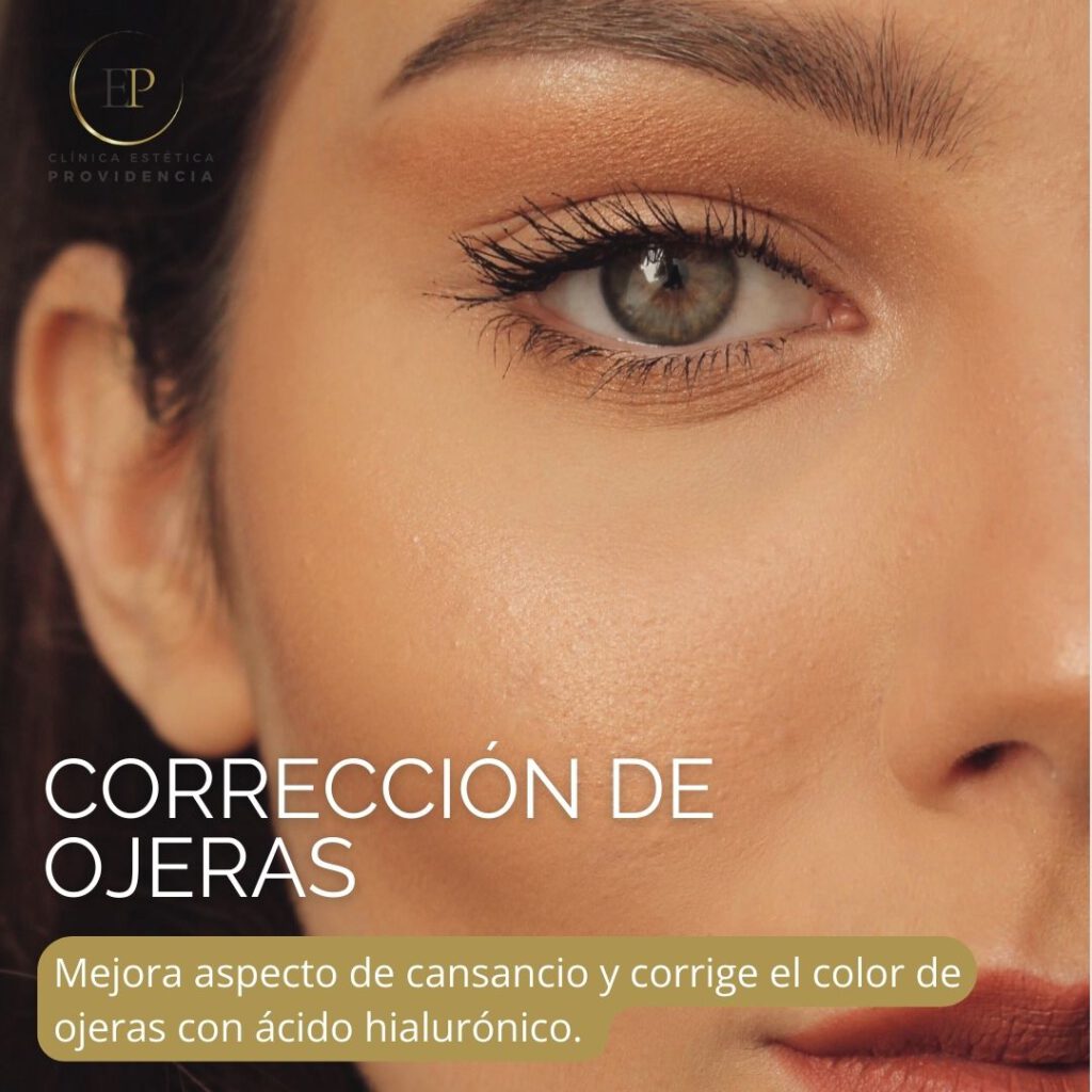 Corrección de ojeras - Clínica Estética Providencia